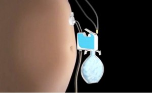 Aspire Assit, a weight loss gadget that will suck your Calories ...